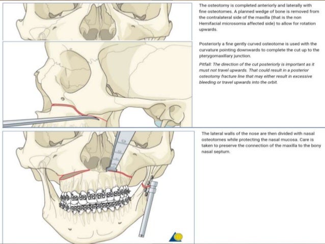canted occlusal plane