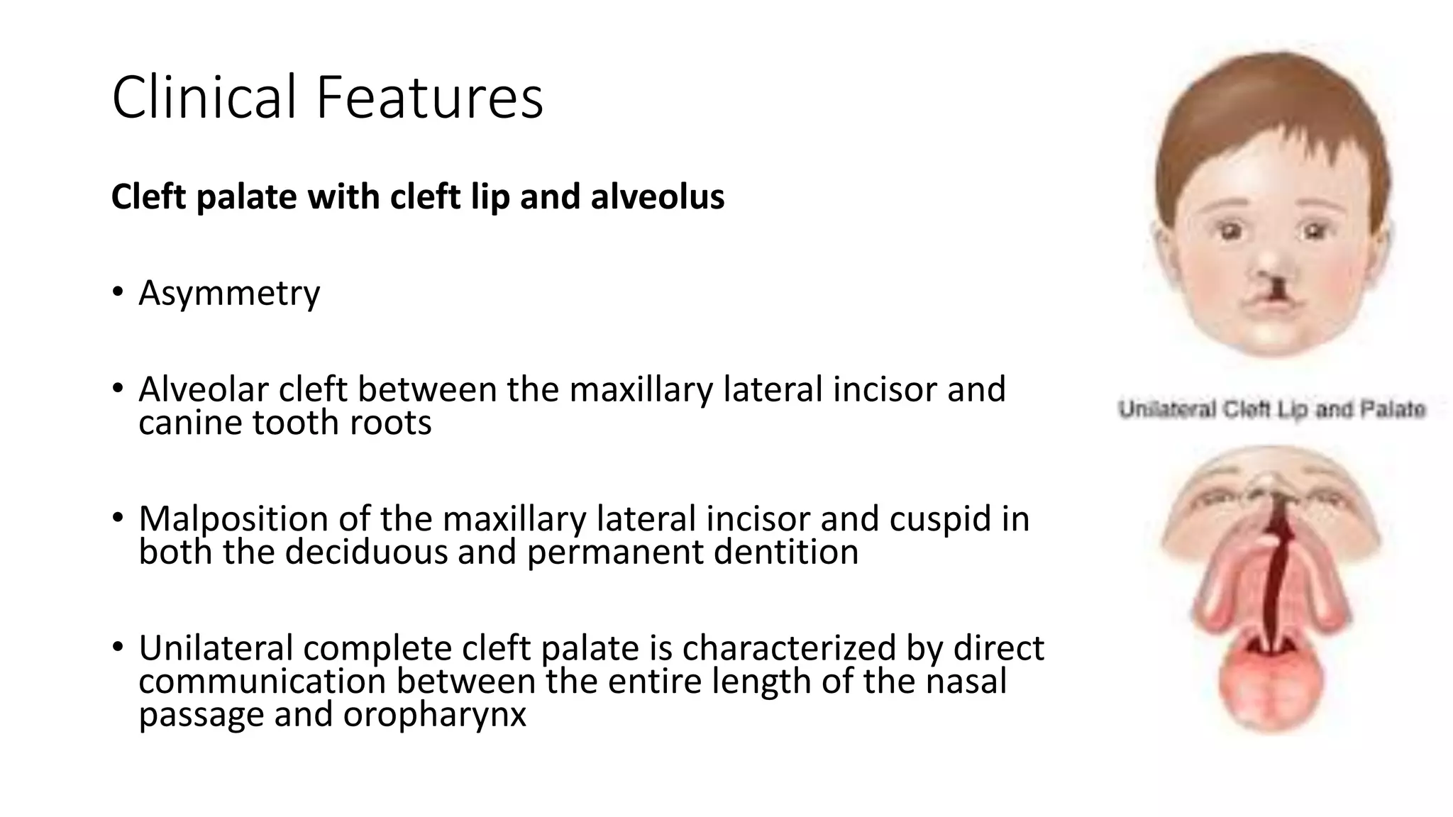 Cleft Palate.pptx
