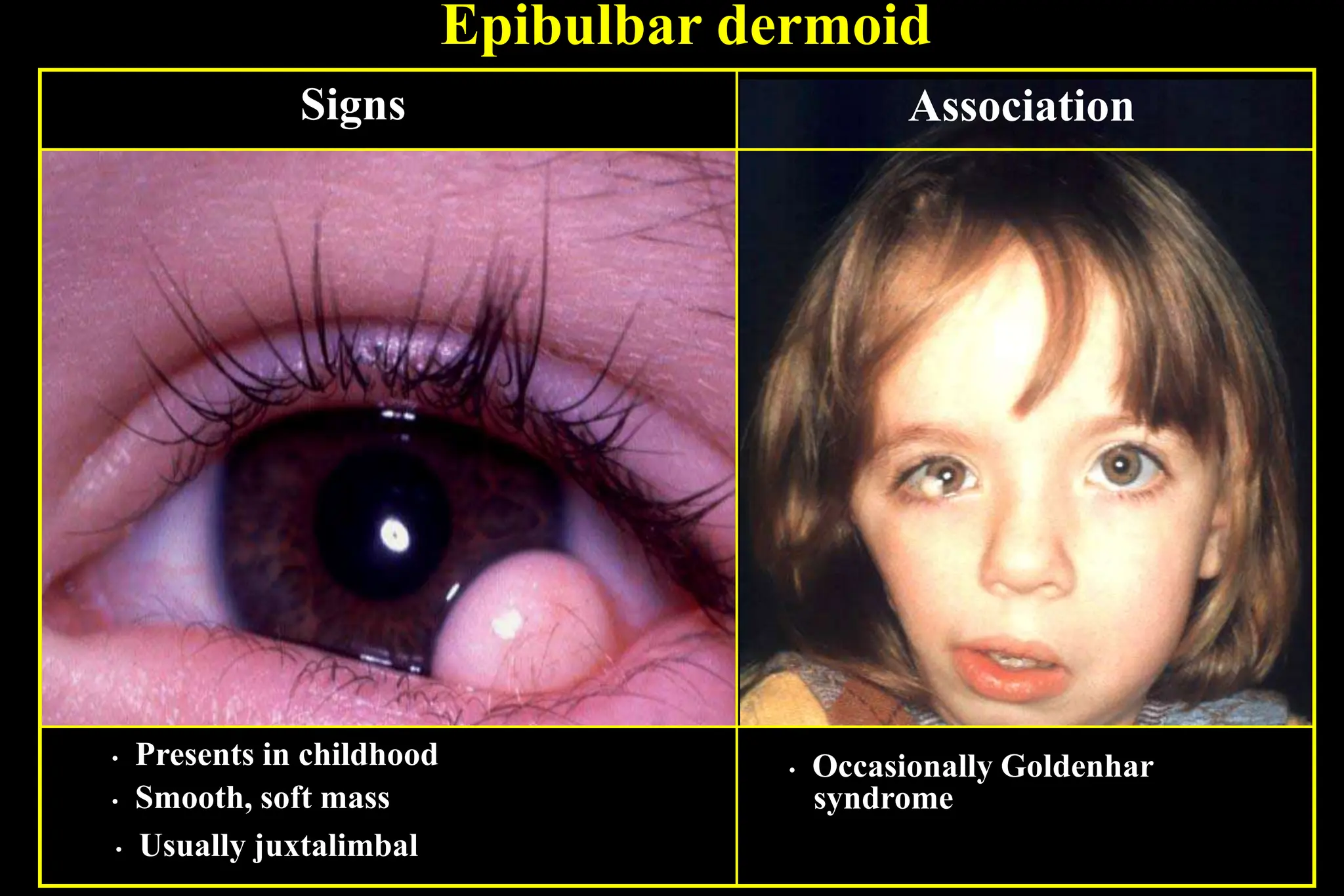 Conjunctival Tumours.ppt