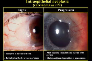 Conjunctival Tumours.ppt