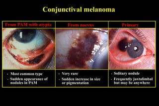 Conjunctival Tumours.ppt