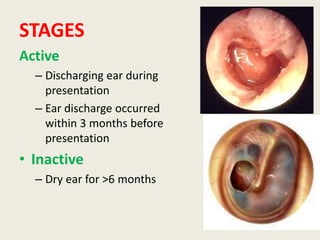 12 csom tubotympanic | PPT