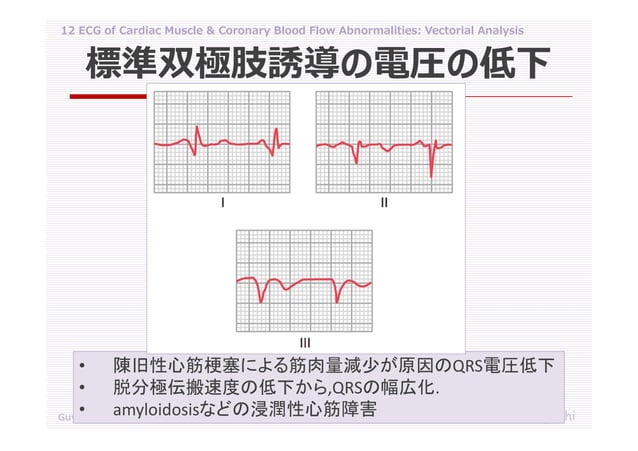 12 ecg of cardiac muscle & coronary blood flow abnormalities vectorial ...