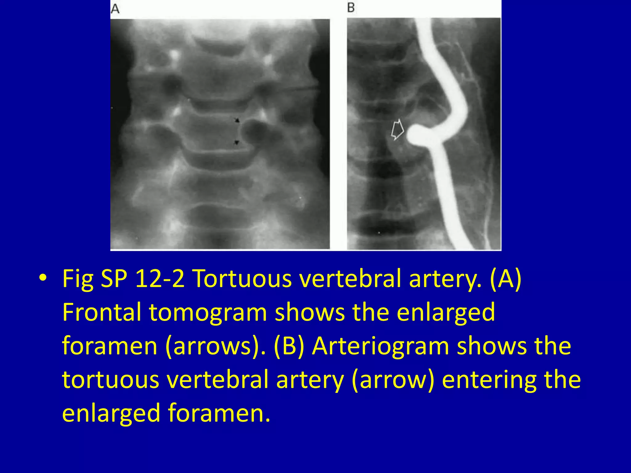 12 enlarged cervical intervertebral foramen | PPT
