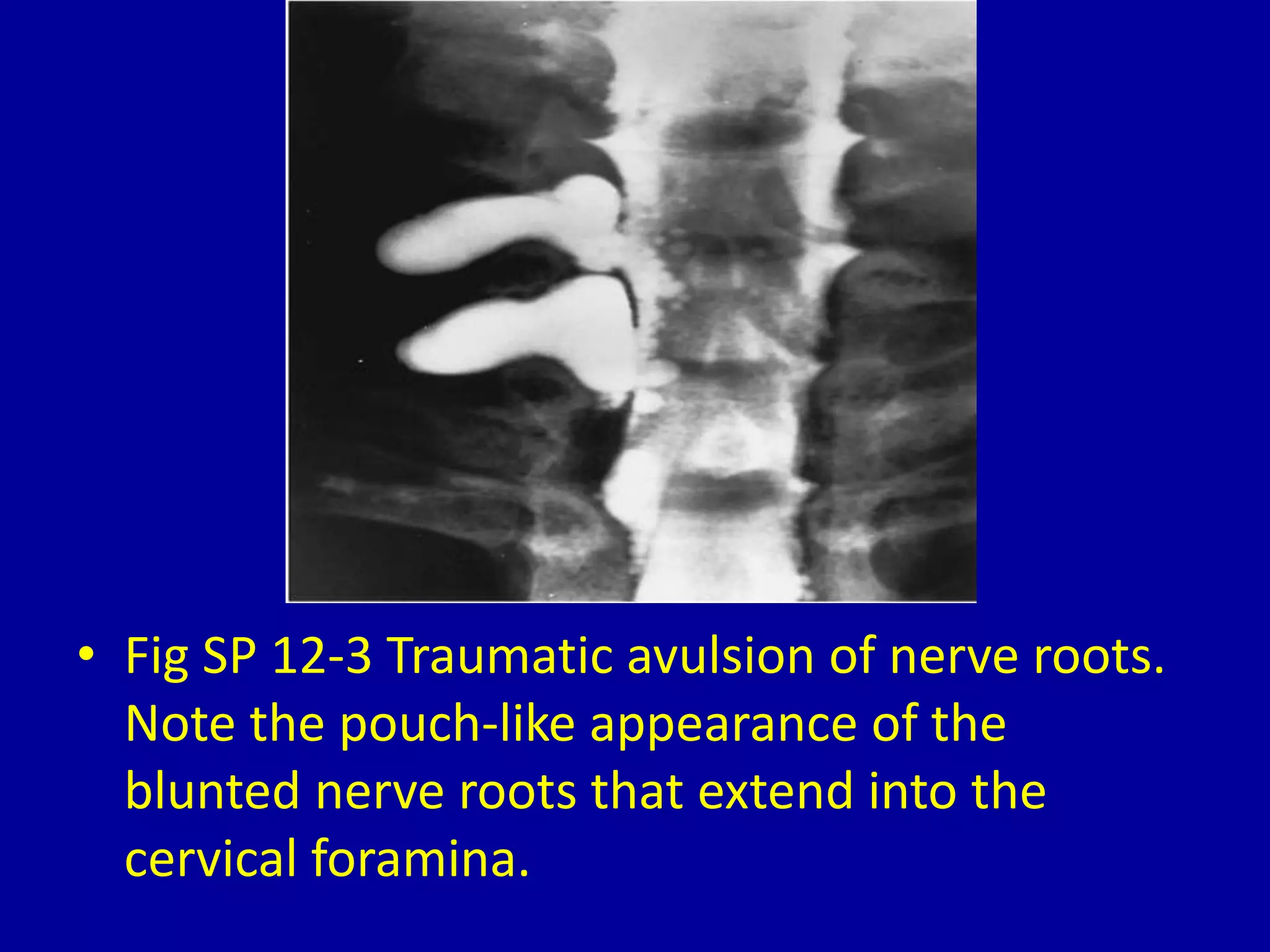 12 enlarged cervical intervertebral foramen | PPT