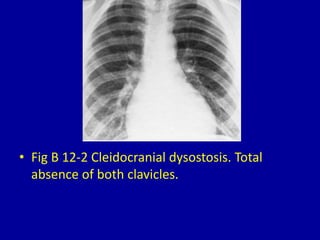 12 erosion, destruction, or defect of | PPT
