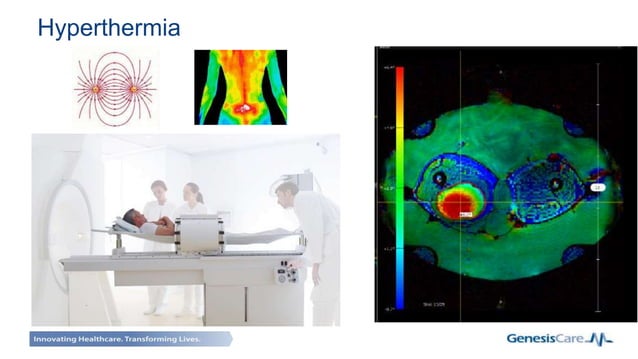 Felix Navarro - Hyperthermia | PPTX | Cancer | Diseases and Conditions
