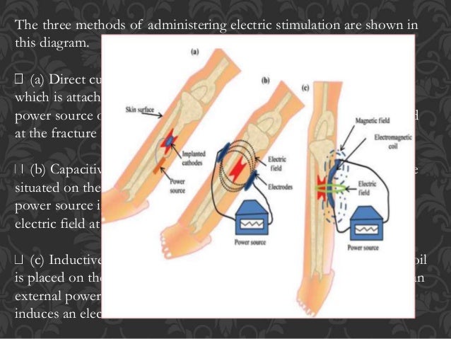 antibiotic coated nails in orthopedic, antibiotic nail