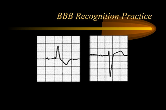 12LeadBlocks.ppt 12 Lead ECGs: Bundle Branch Blocks & Hemiblocks | PPT