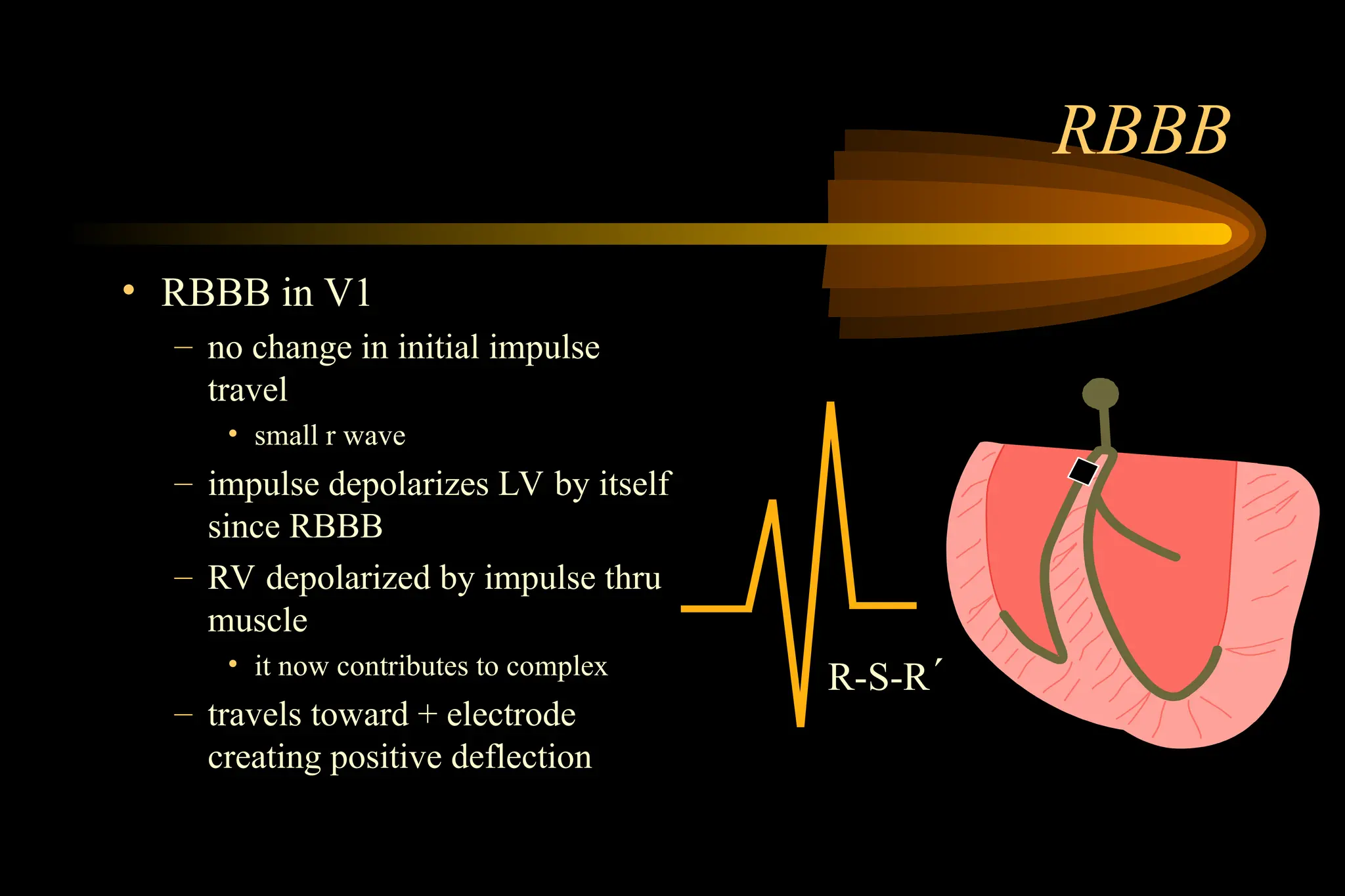 12LeadBlocks.ppt 12 lead bundle branch block | PPT