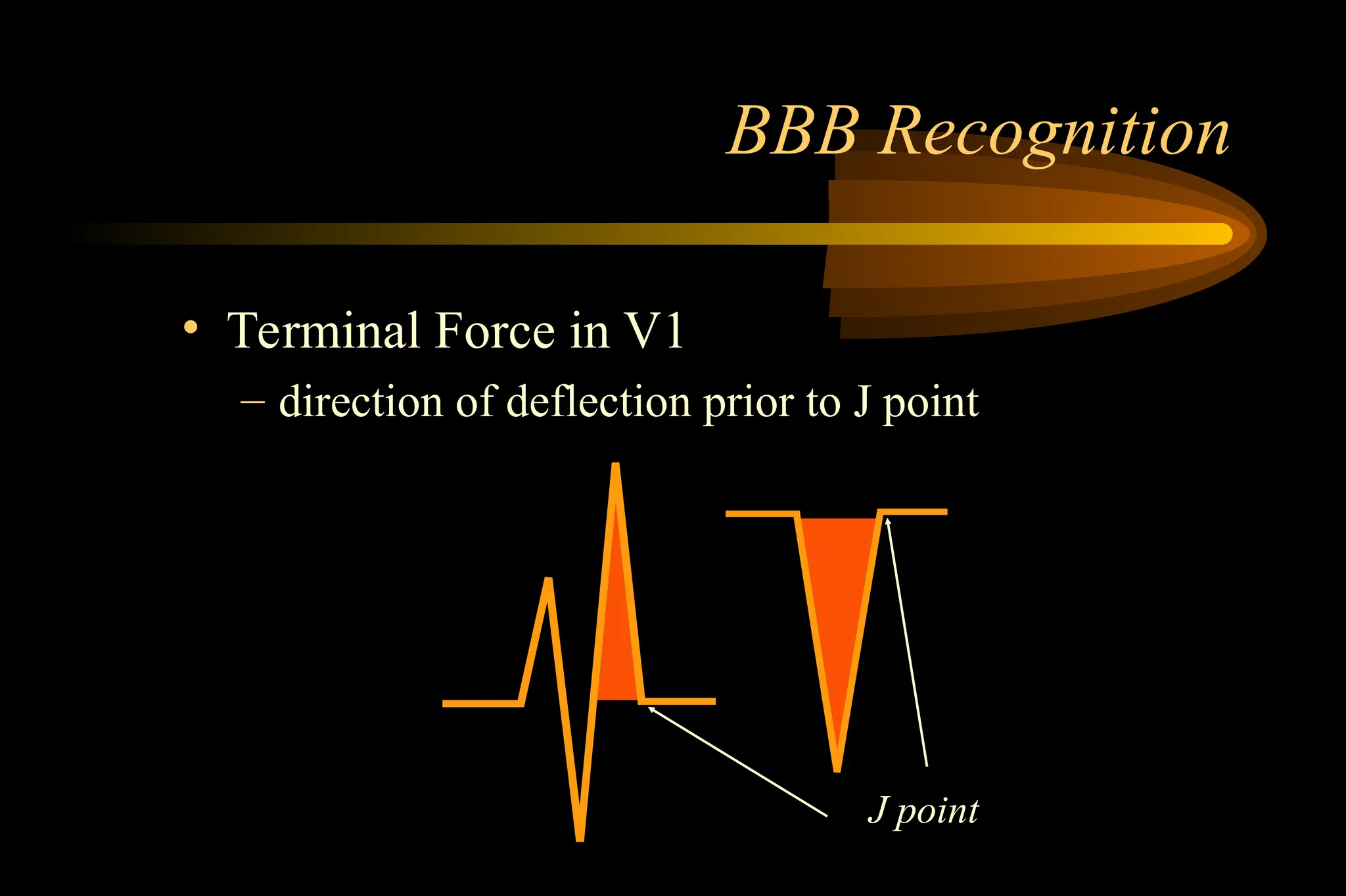 12LeadBlocks.ppt 12 lead bundle branch block | PPT