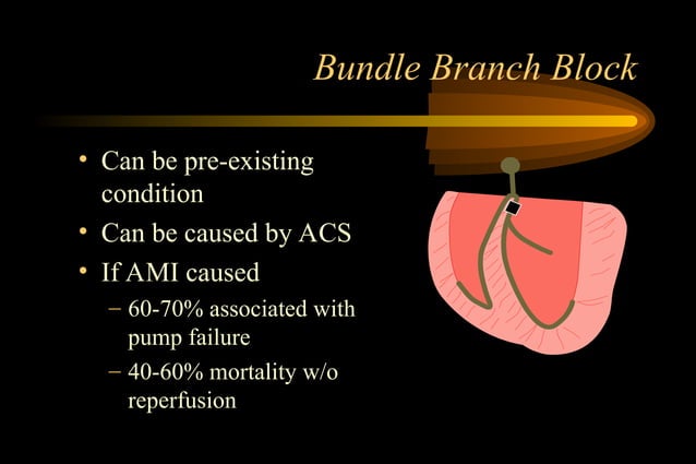 12LeadBlocks.ppt 12 lead bundle branch block | PPT