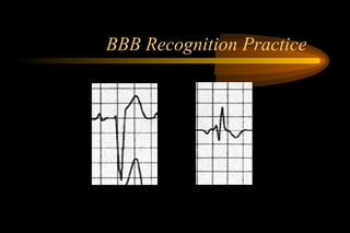 12LeadBlocks.ppt 12 lead bundle branch block | PPT