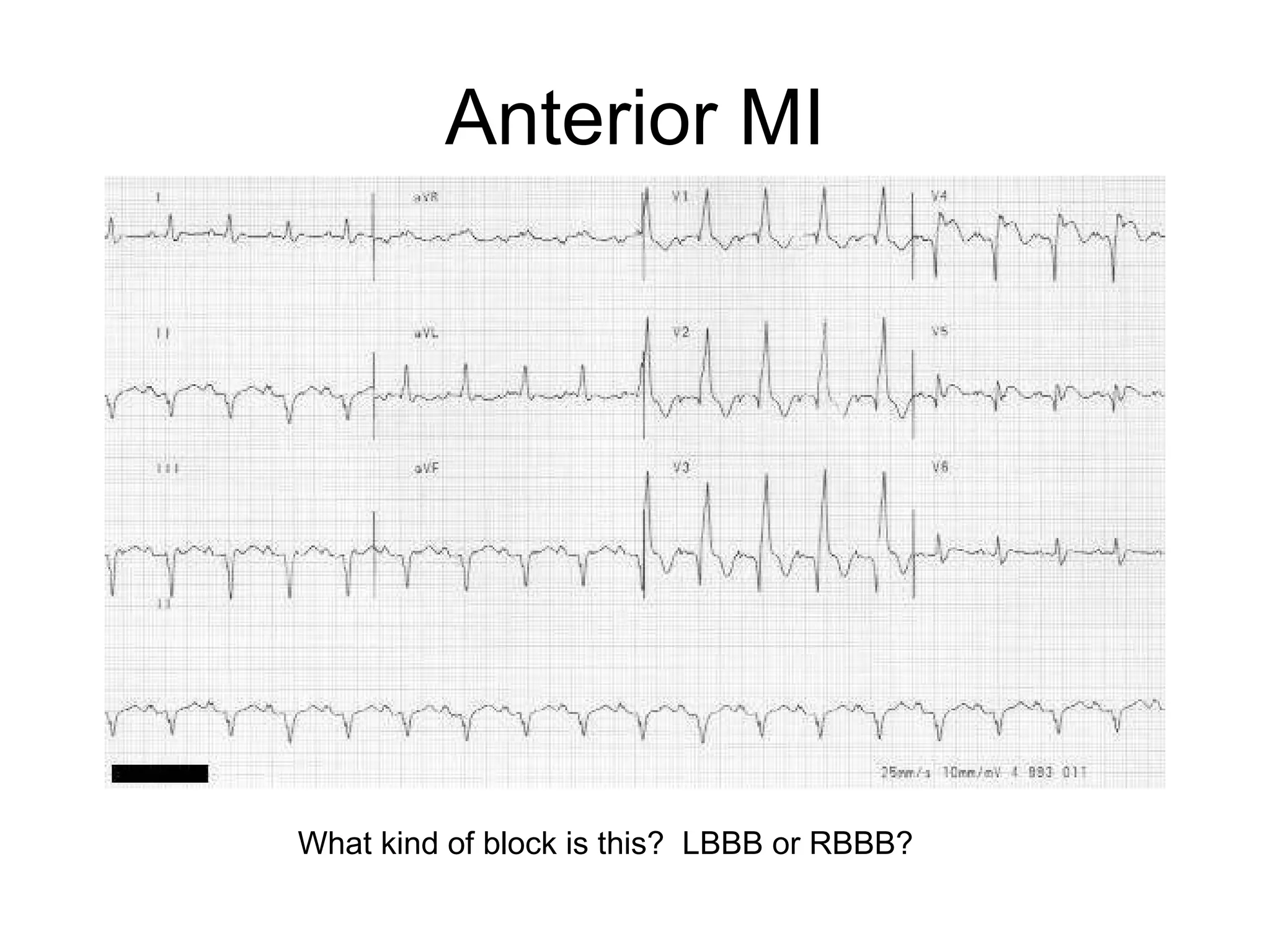 12 lead ecg | PPT