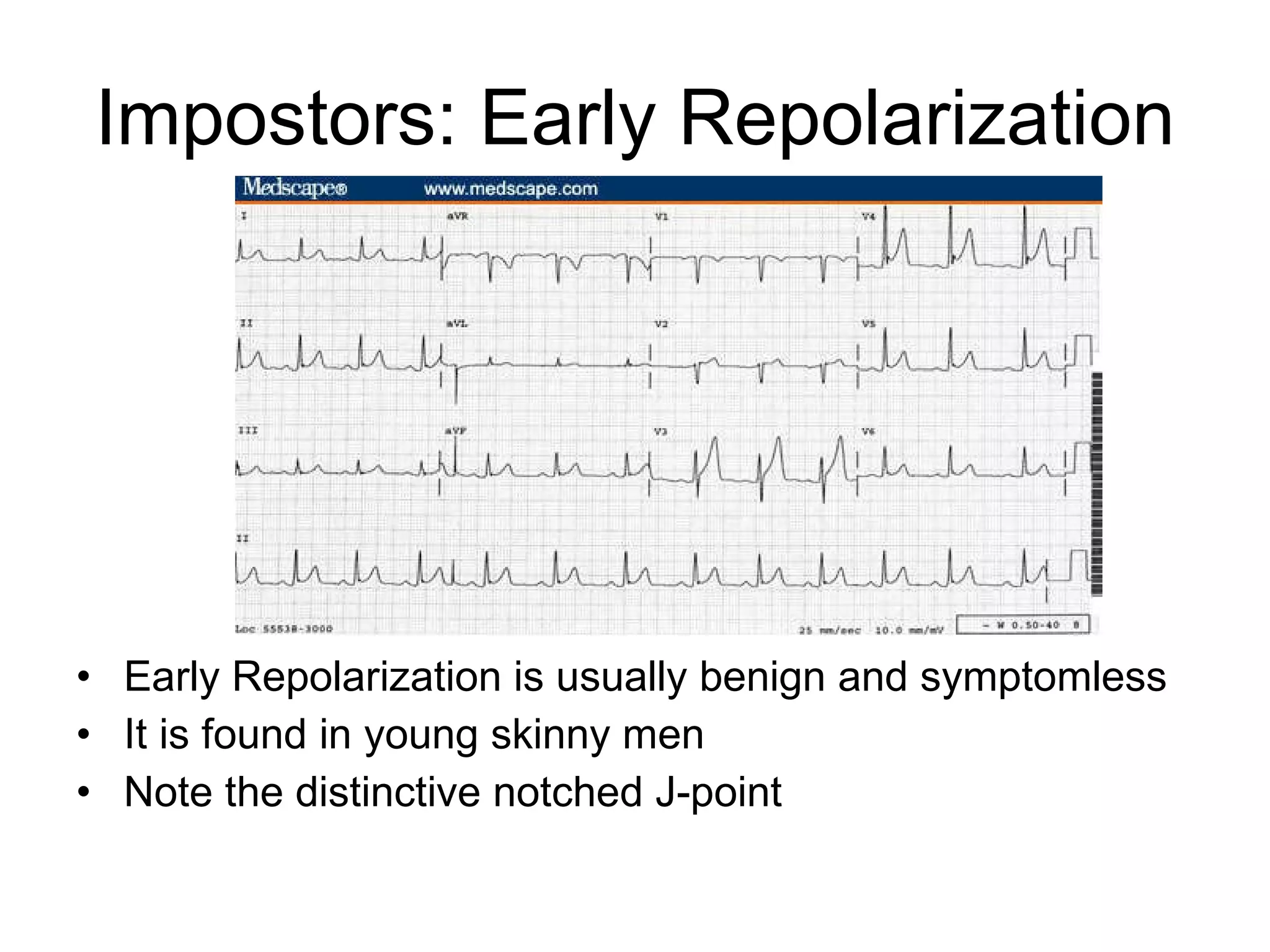 12 lead ecg | PPT