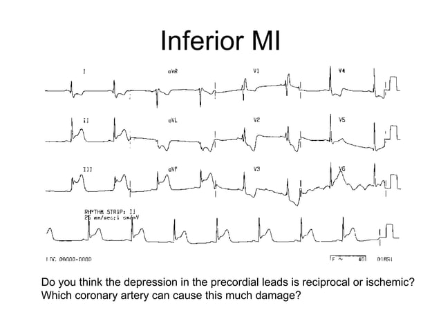 12 lead ecg | PPT | Heart and Cardiovascular Diseases | Diseases and ...