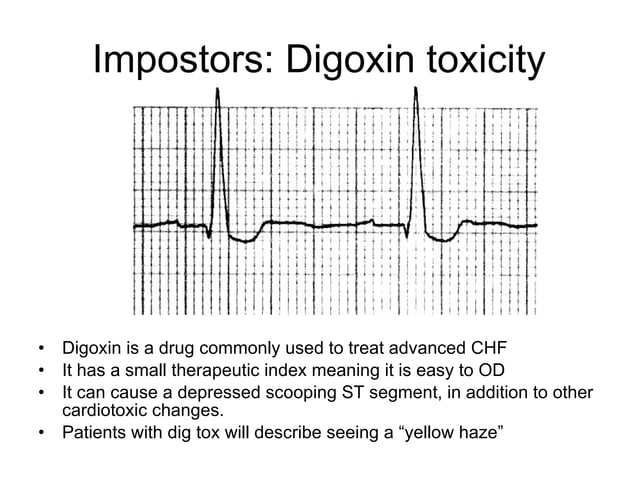12 lead ecg | PPT | Heart and Cardiovascular Diseases | Diseases and ...