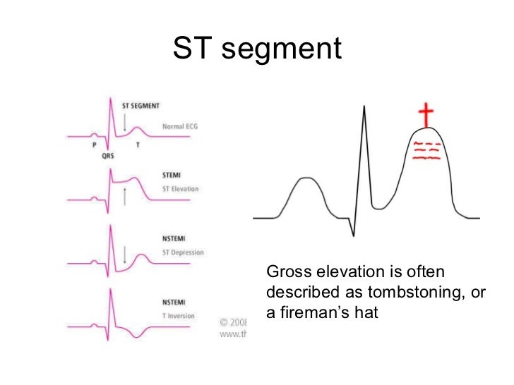 12 lead ecg