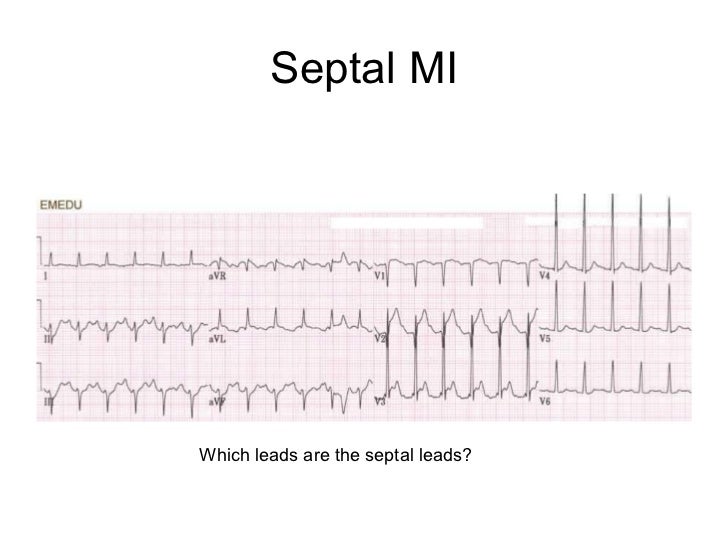 [DIAGRAM] 12 Lead Diagram Septal - MYDIAGRAM.ONLINE