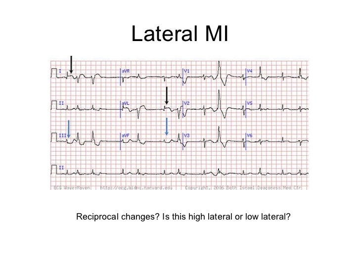 12 lead ecg