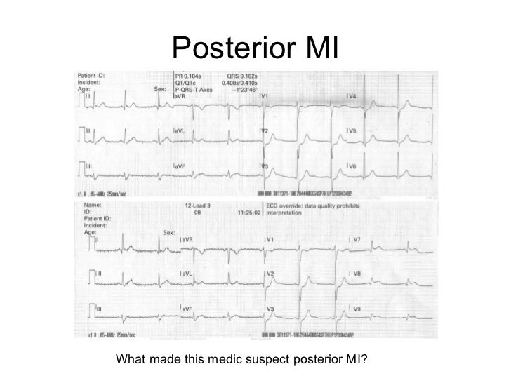 12 lead ecg