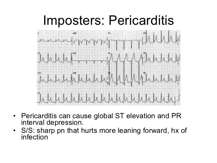 12 lead ecg
