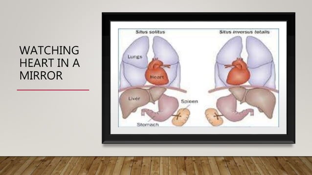 12 lead ecg of situs inversus dextrocardia