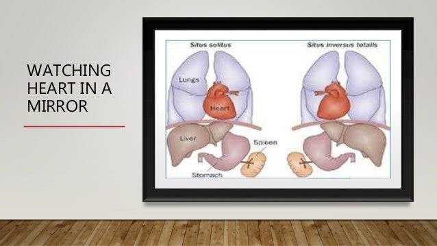 12 lead ecg of situs inversus dextrocardia