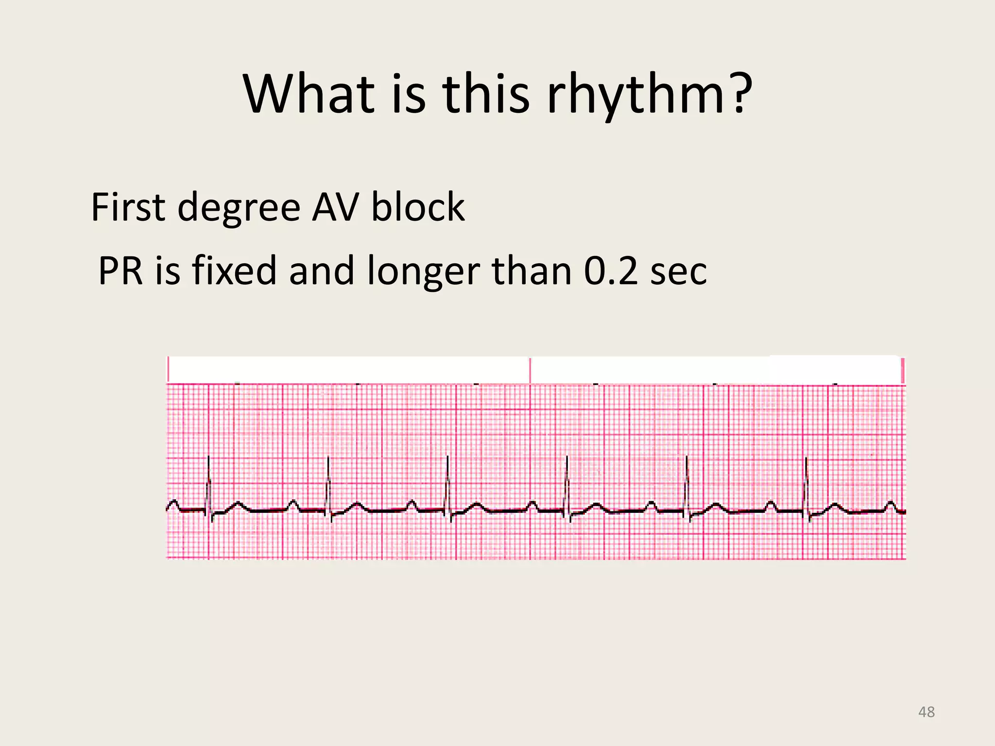 12 Lead EKG Interpretation ( PDFDrive ).pdf