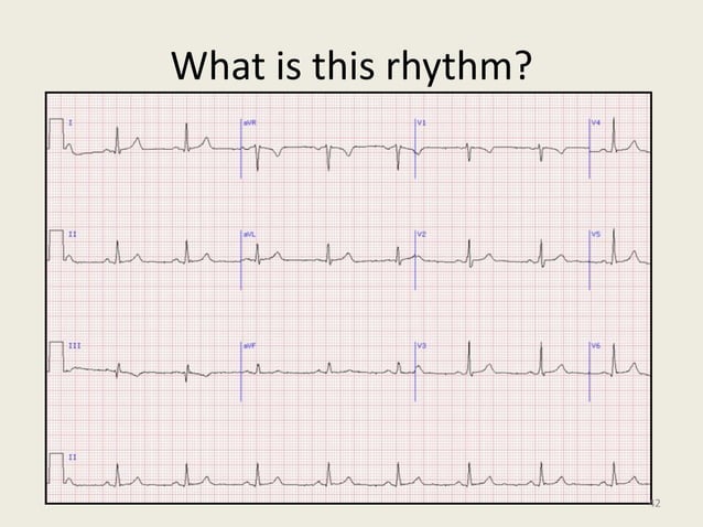 12 Lead EKG Interpretation ( PDFDrive ).pdf