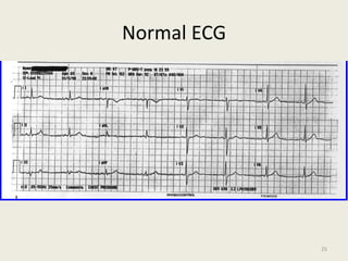 Normal 12 Lead Ecg Labeled