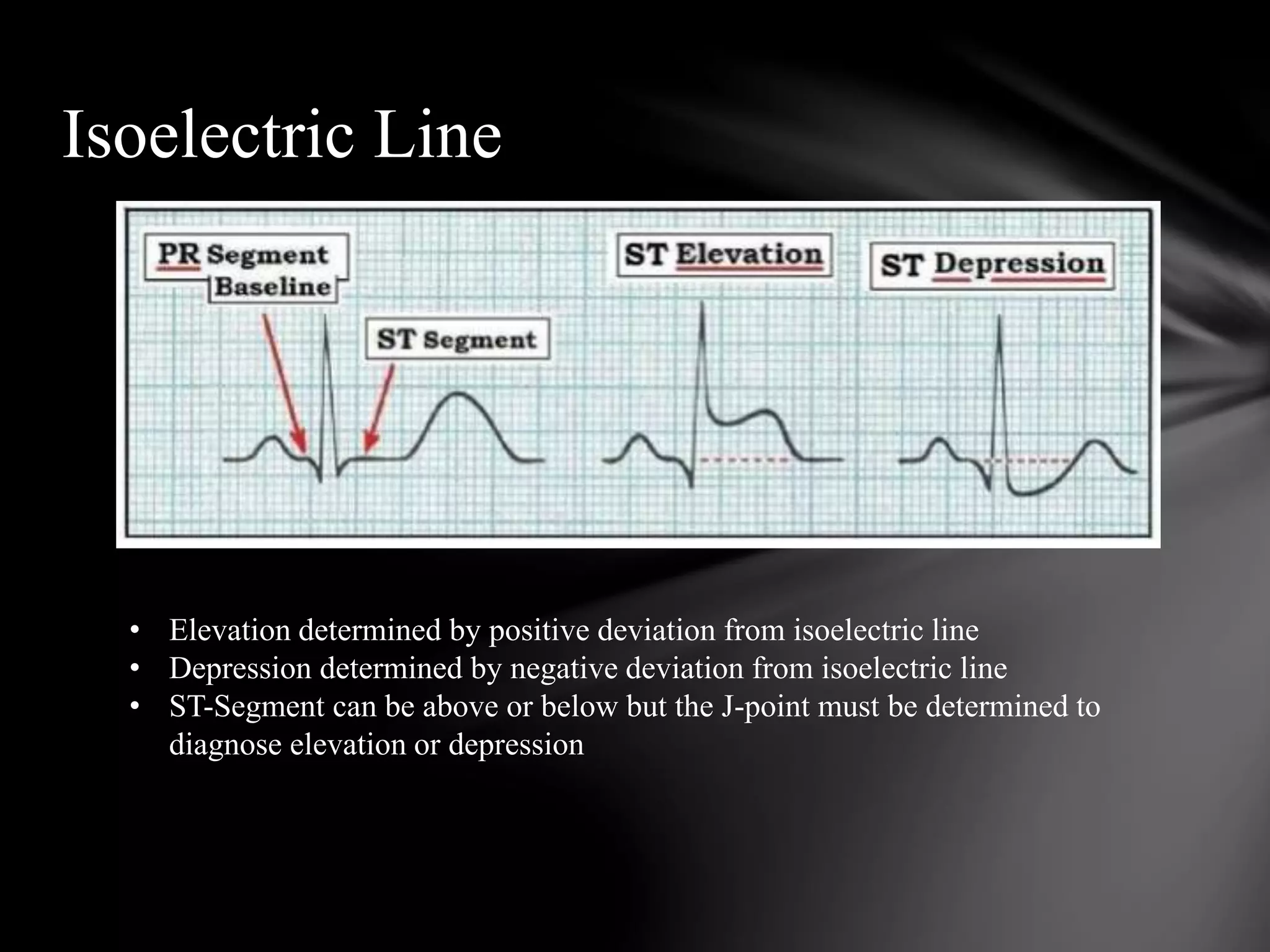 12 lead interpretation | PPTX
