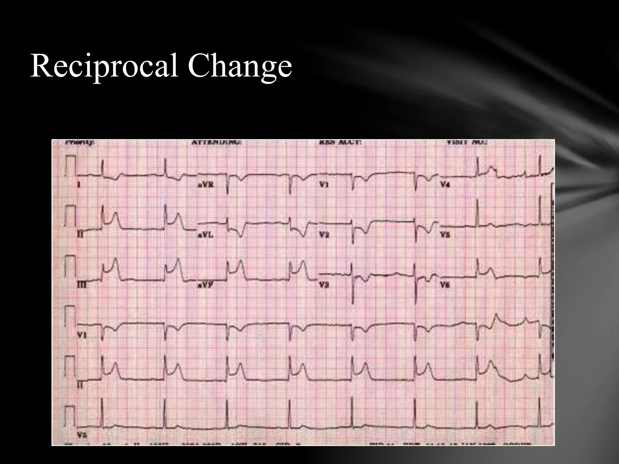 12 lead interpretation | PPTX | Heart and Cardiovascular Diseases ...