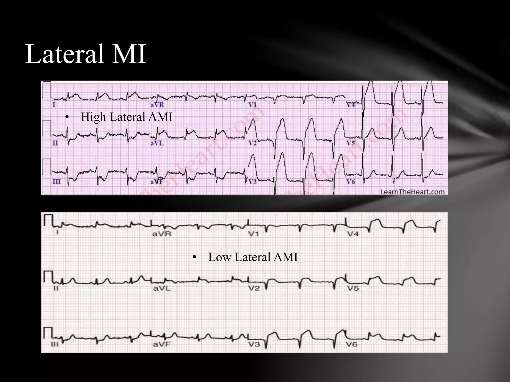 12 lead interpretation | PPTX