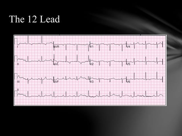 12 lead interpretation | PPTX | Heart and Cardiovascular Diseases ...