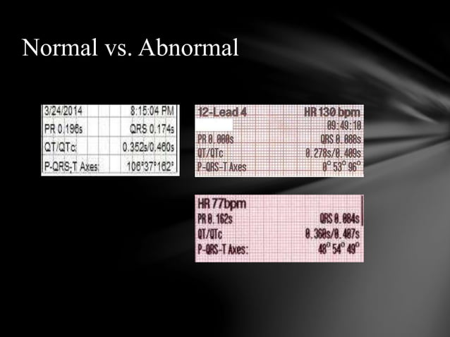 12 lead interpretation | PPTX | Heart and Cardiovascular Diseases ...