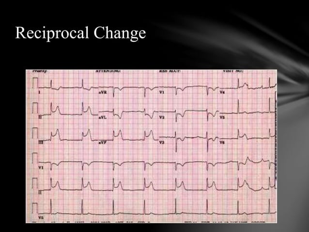 12 lead interpretation | PPTX | Heart and Cardiovascular Diseases ...