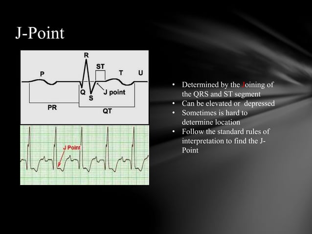 12 lead interpretation | PPTX | Heart and Cardiovascular Diseases ...