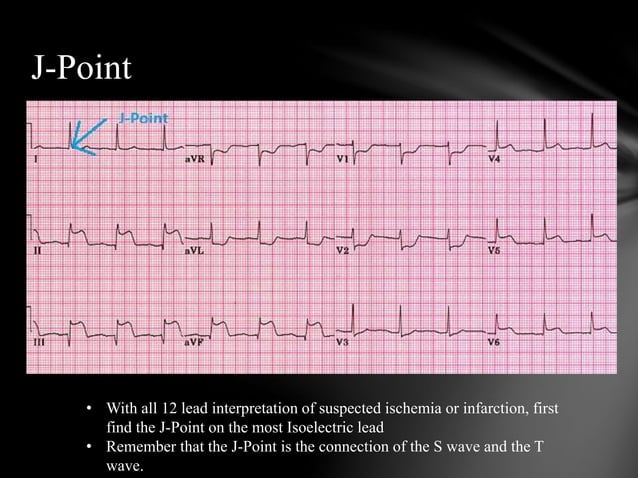 12 lead interpretation | PPTX | Heart and Cardiovascular Diseases ...