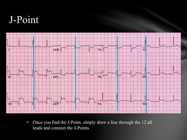 12 lead interpretation | PPTX | Heart and Cardiovascular Diseases ...