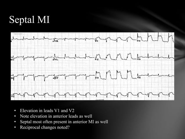 12 lead interpretation | PPTX | Heart and Cardiovascular Diseases ...