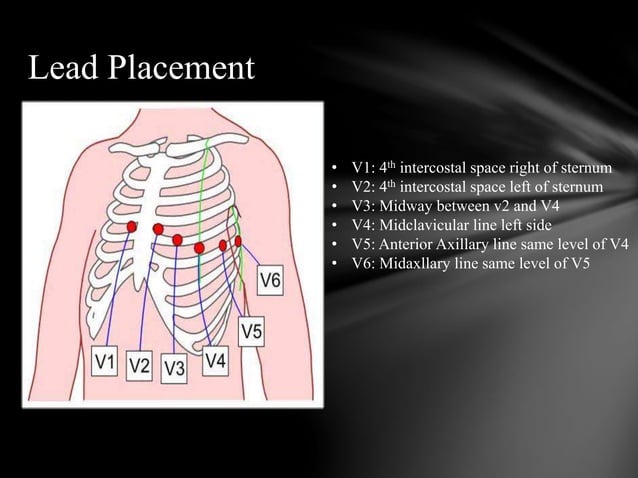 12 lead interpretation | PPTX | Heart and Cardiovascular Diseases ...