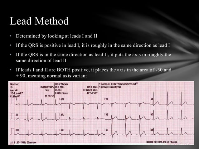 12 lead interpretation
