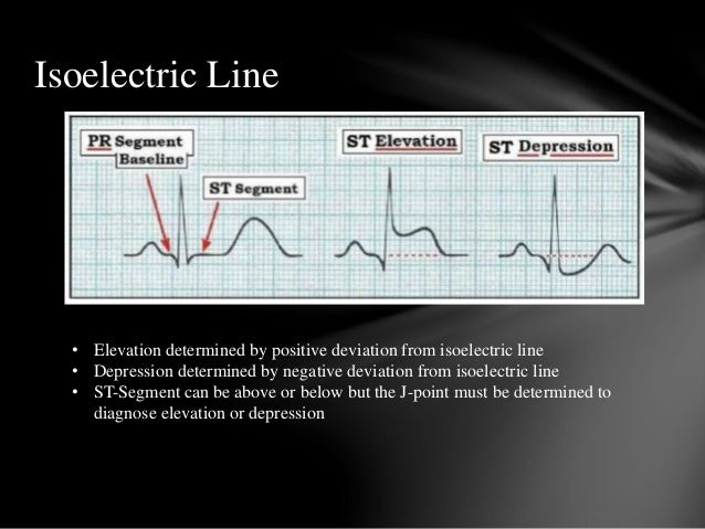 12 lead interpretation