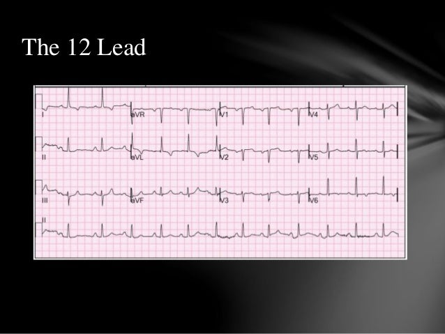 12 lead interpretation