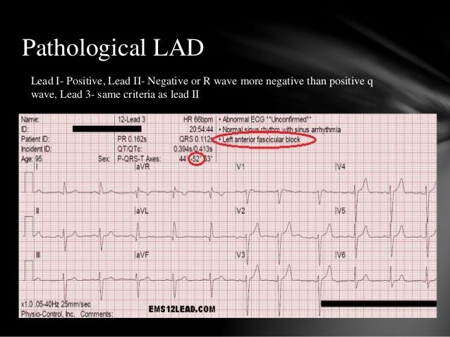 12 lead interpretation