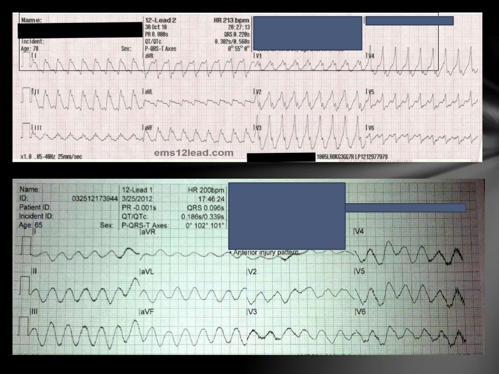 12 lead interpretation