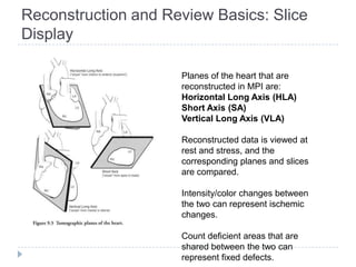 Myocardial perfusion imaging SPECT basics | PPTX