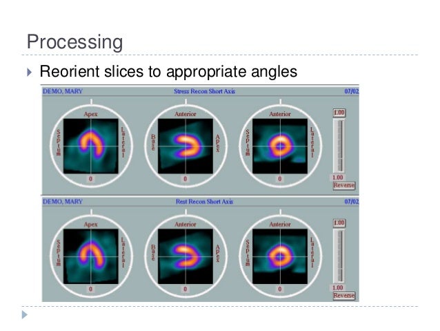 Myocardial perfusion imaging SPECT basics