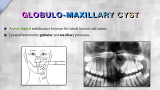 Non Odontogenic Cysts | PDF